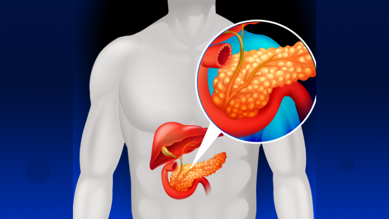 Understanding Pancreatitis: Exploring Its Different Types - Gastro Doc