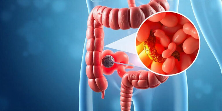 How Microscopic Colitis Can Lead to Persistent Diarrhea? - Gastro Doc